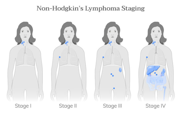 Roundup Cancer Lawsuit | 2020 Updates & Settlements
